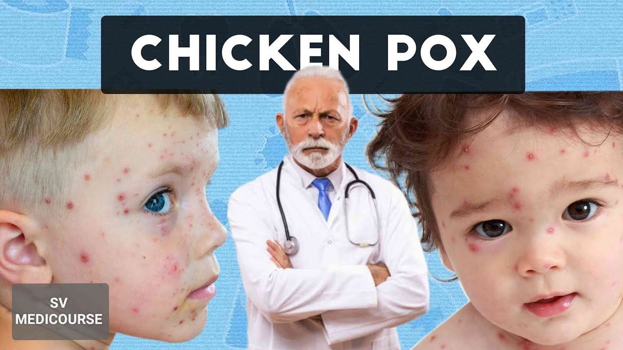 Chicken pox (छोटी माता) Definition, cause, sign and symptoms ...