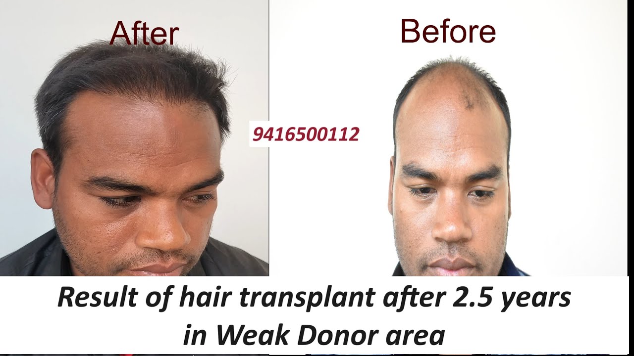 Result of hair transplant in weak donor area after 2.5 Years | Dr ...