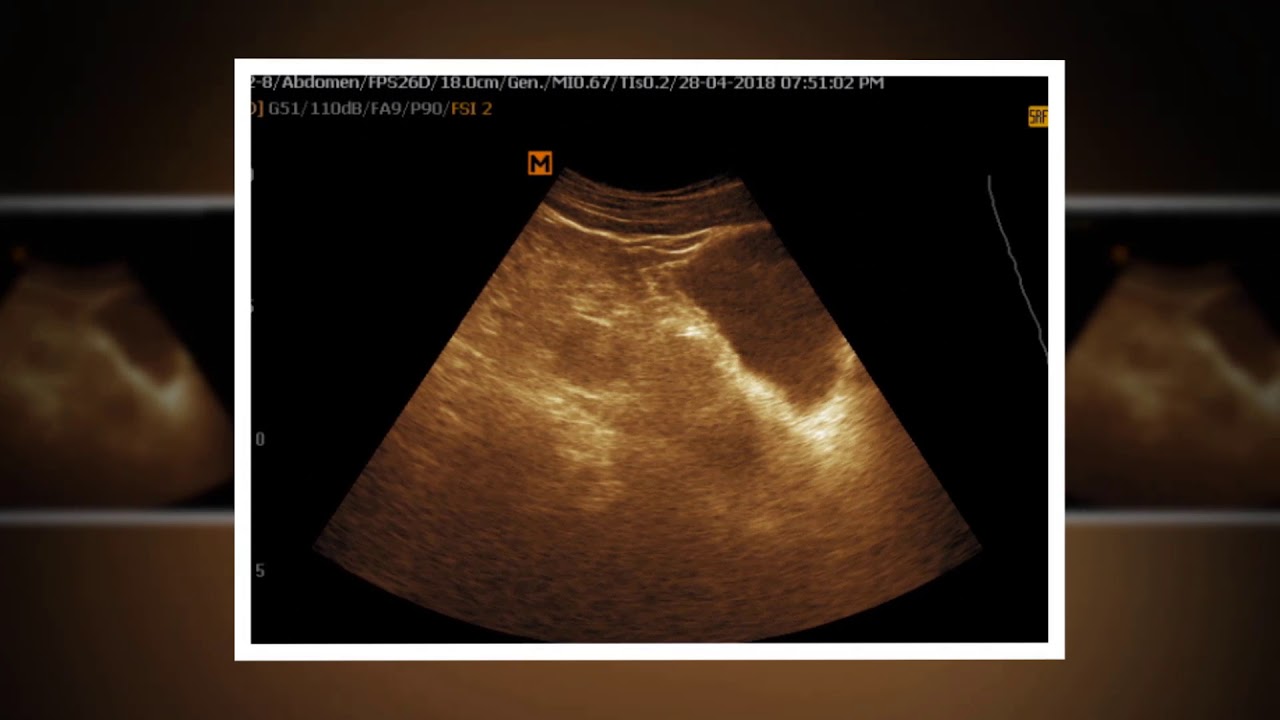 Ultrasound cases 452 of 2000 || Right Ectopic Kidney - YouTube