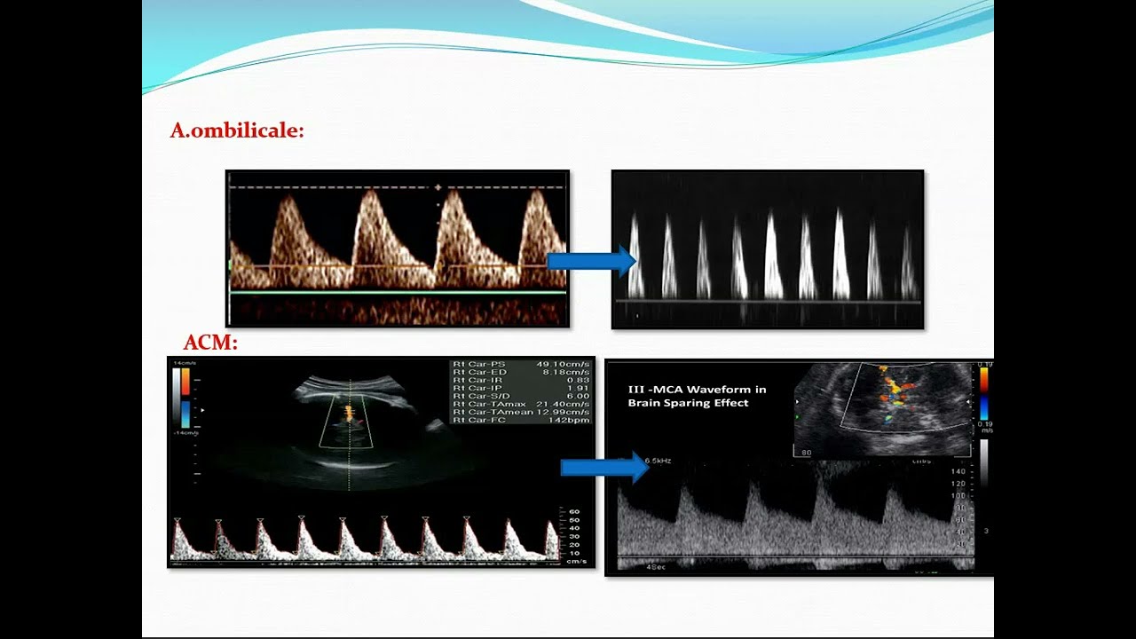 Doppler Obstétrical - YouTube