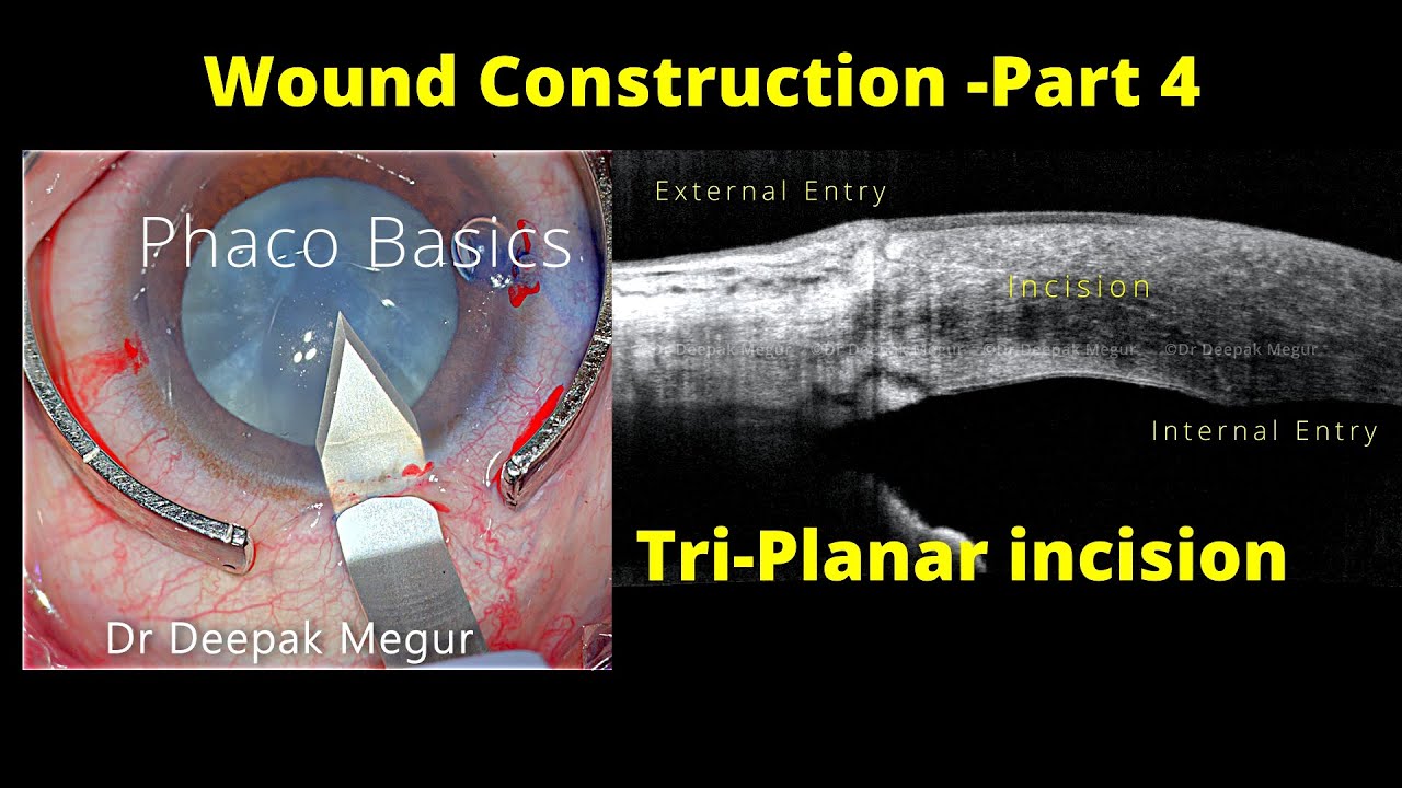 Phaco Basics- Incisions Part4- Understanding TriPlanar , Bi Planar ...