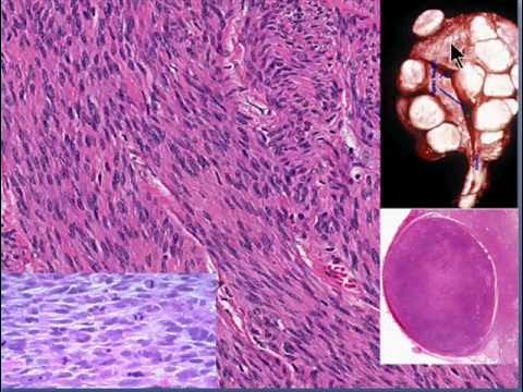 Medical School Pathology, Chapter 7c - YouTube