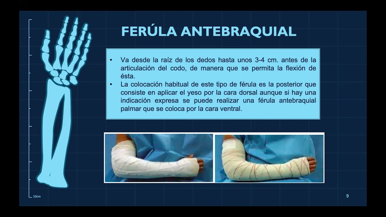 COLOCACIÓN DE FÉRULAS EN MIEMBRO SUPERIOR - TRAUMATOLOGÍA - YouTube