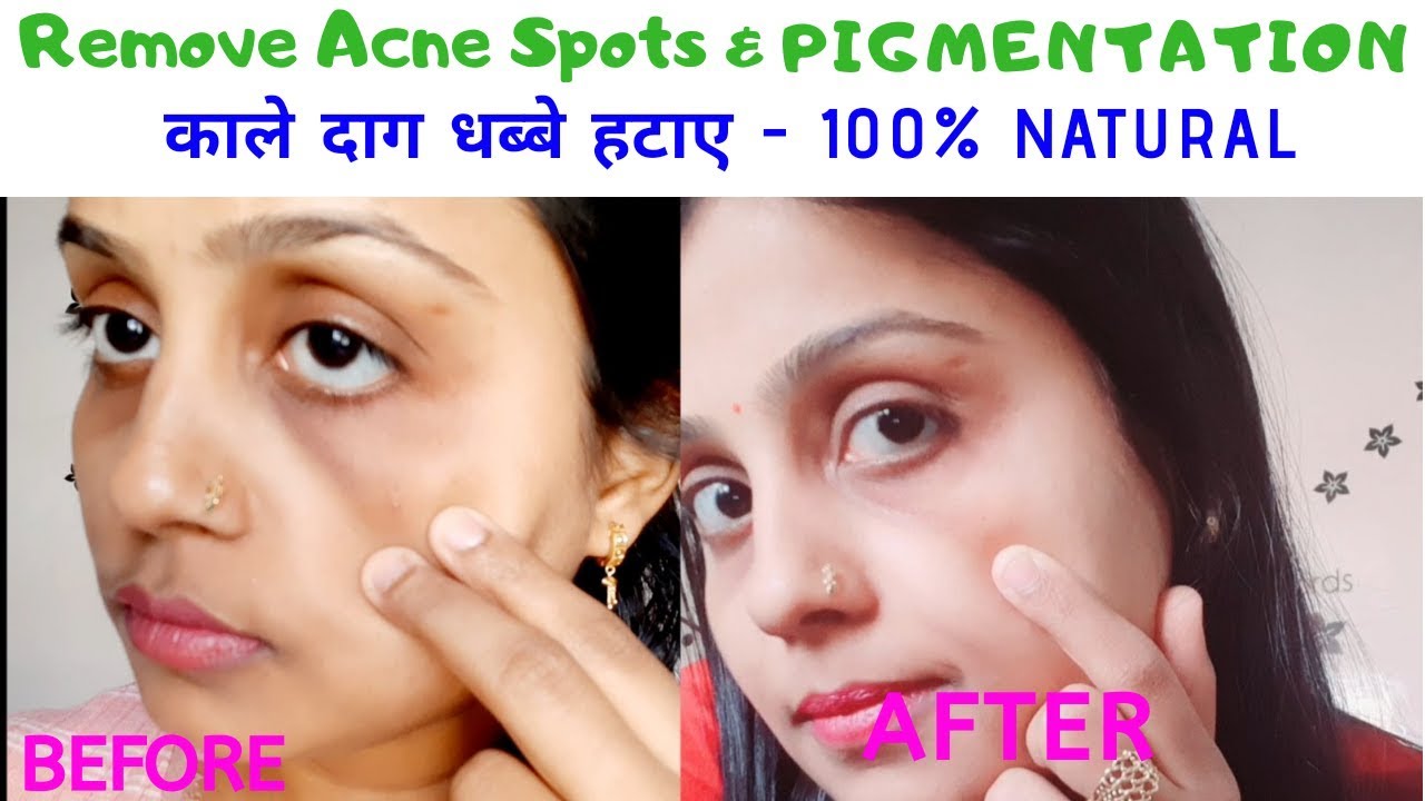 Remove DARK SPOTS, Pigmentation & ACNE SCARS in 5 Days | 100% NATURAL ...