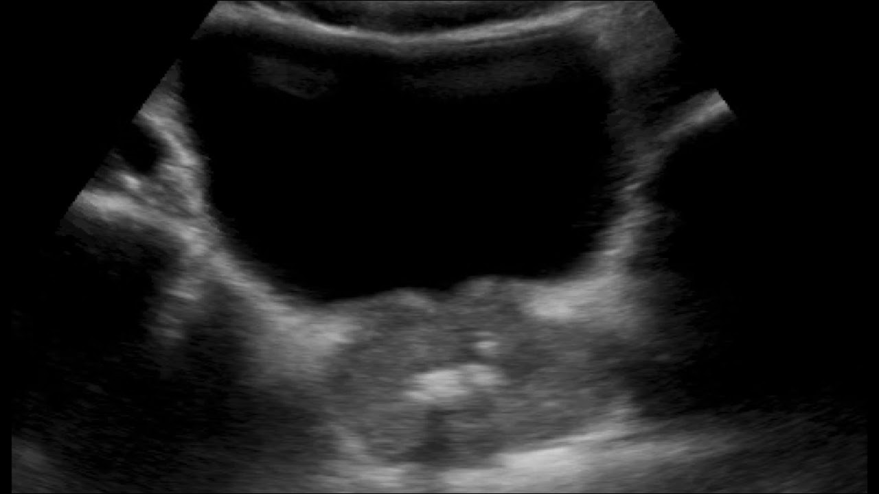 Video 49.2 C: FAST Pelvic View - YouTube
