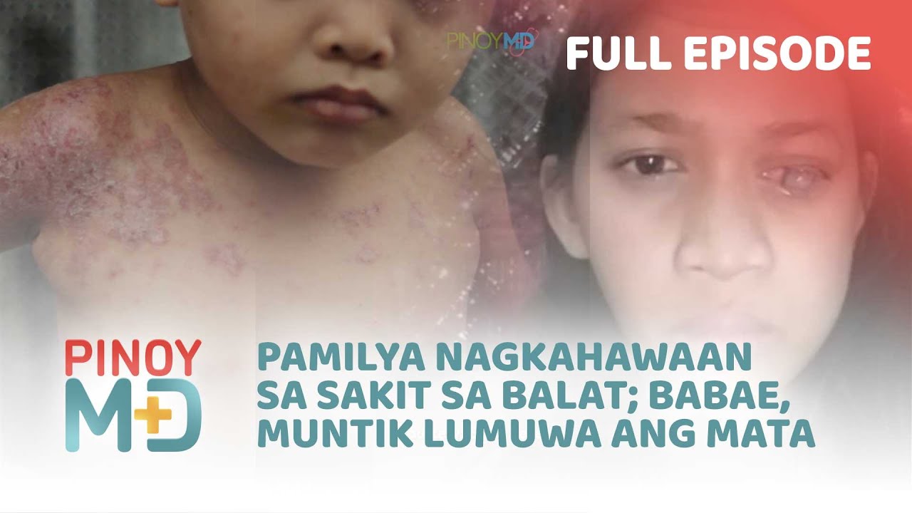 Pamilya nagkahawaan sa sakit sa balat; Babae, muntik lumuwa ang mata ...