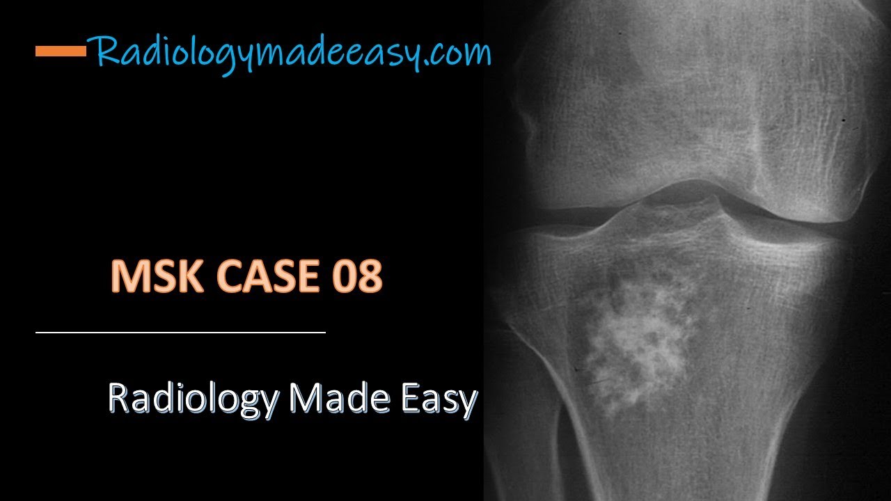 FRCR Radiology MSK case 08 : A 25 year old patient presented with knee ...