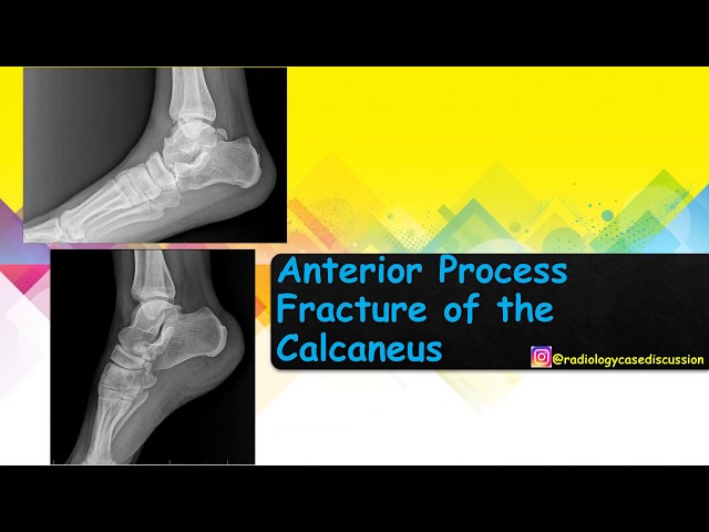 Anterior Calcaneus Fracture