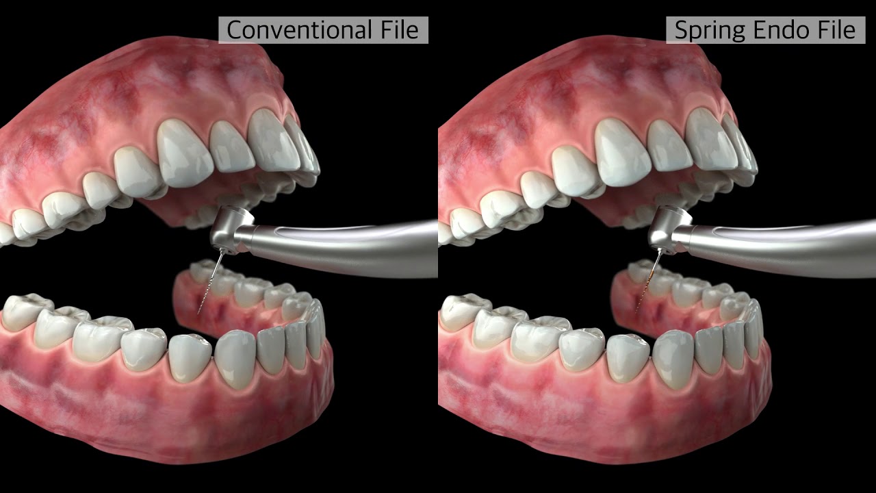 Spring endo file EN 1201 - YouTube