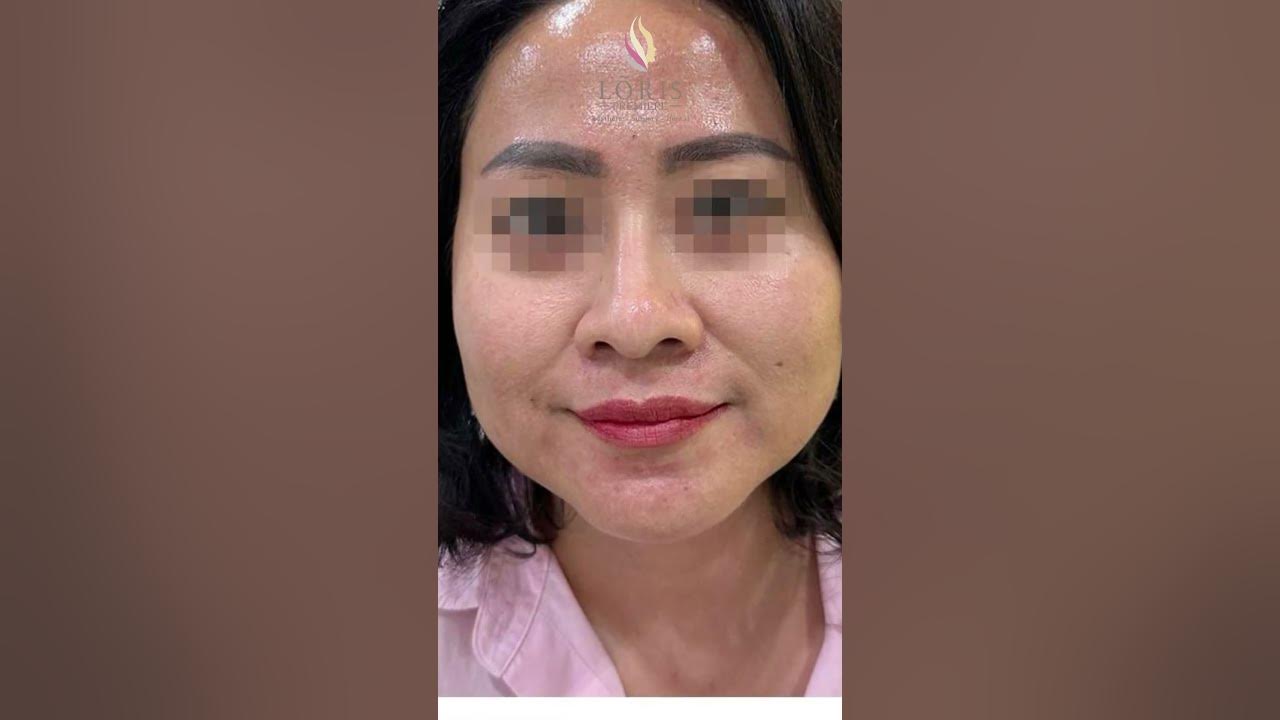 PIPI CHUBBY HEMPAS DENGAN BUCCAL FAT REMOVAL #buccal #buccalfatremoval #lemak - YouTube