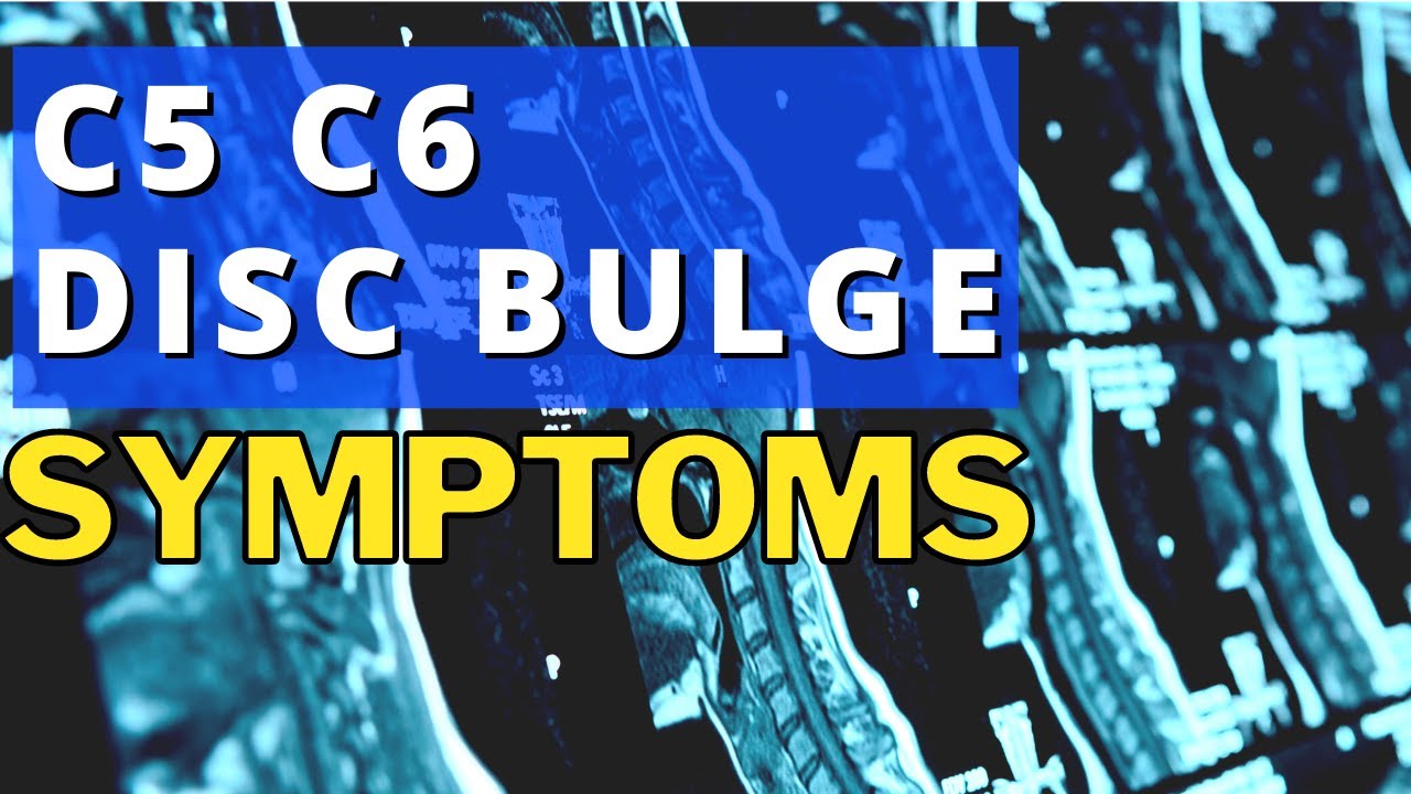 What Are The Symptoms Of A Bulging Disc In The Neck? C5 C6 Disc Bulge ...