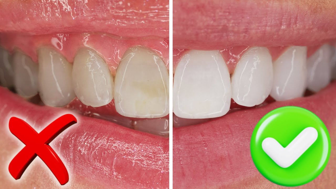 Dentist Reveals How to Whiten Teeth ULTRA WHITE & FAST, How They Stain ...