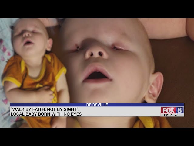 Baby Born Without Eyes