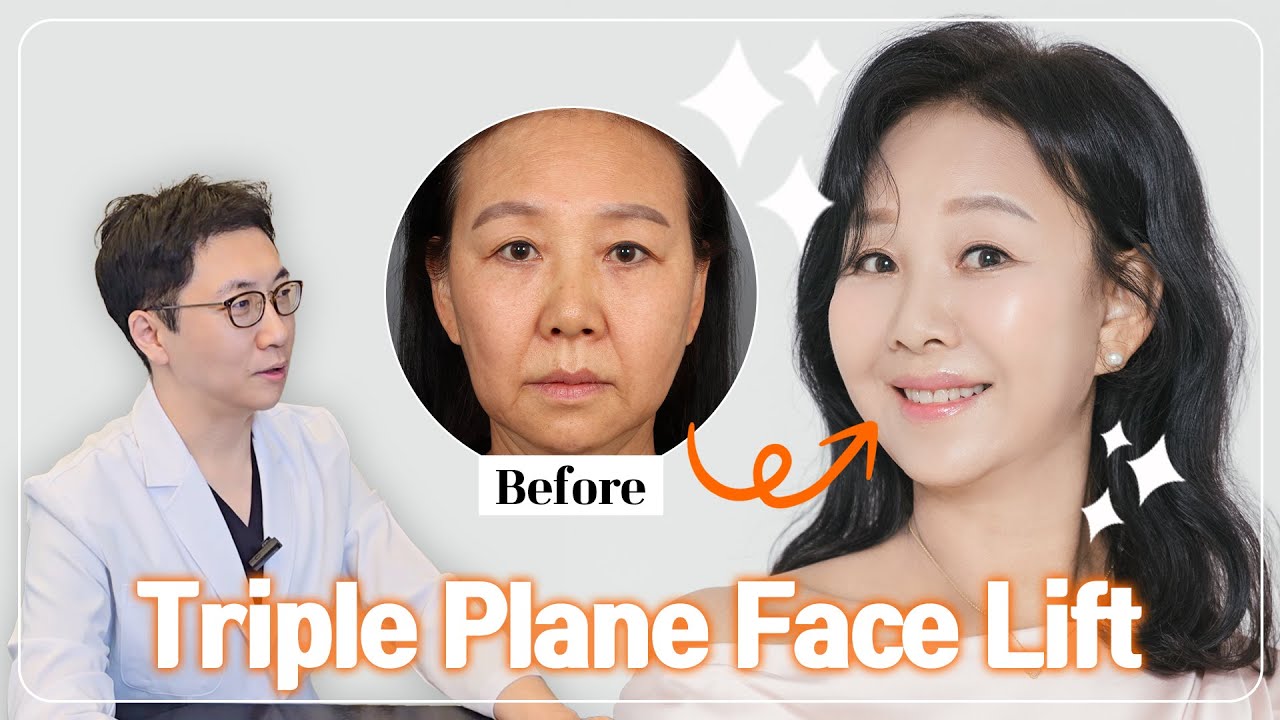 Triple plane face lift (deep plane face lift) - YouTube