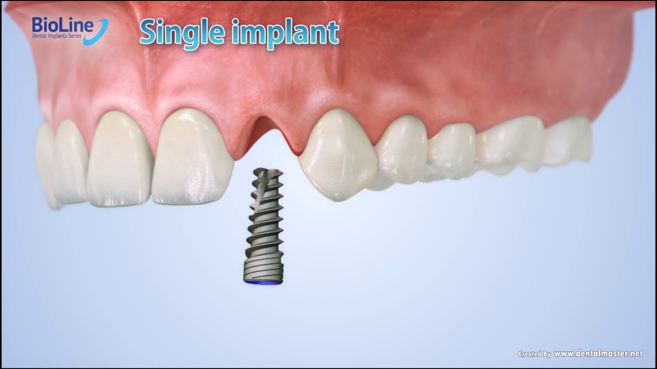 bioline internal Hex Implants protocol Introduction - YouTube