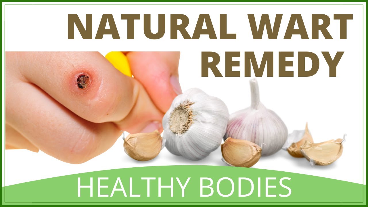 How To Get Rid Of Warts Naturally Fast - YouTube