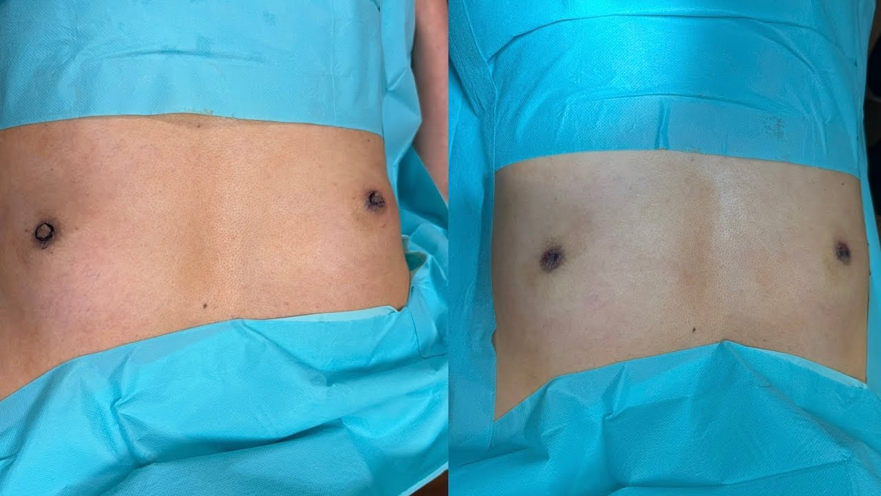 LEBO GYNO & BEYOND AMAZING BEFORE & AFTER IMMEDIATE RESULTS 42 MALE NEW ...