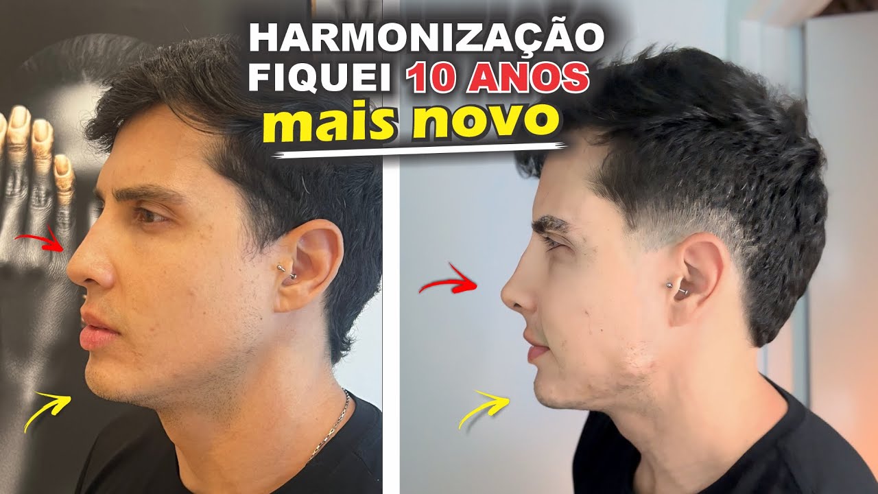 Cirurgia De Mandibula Masculina