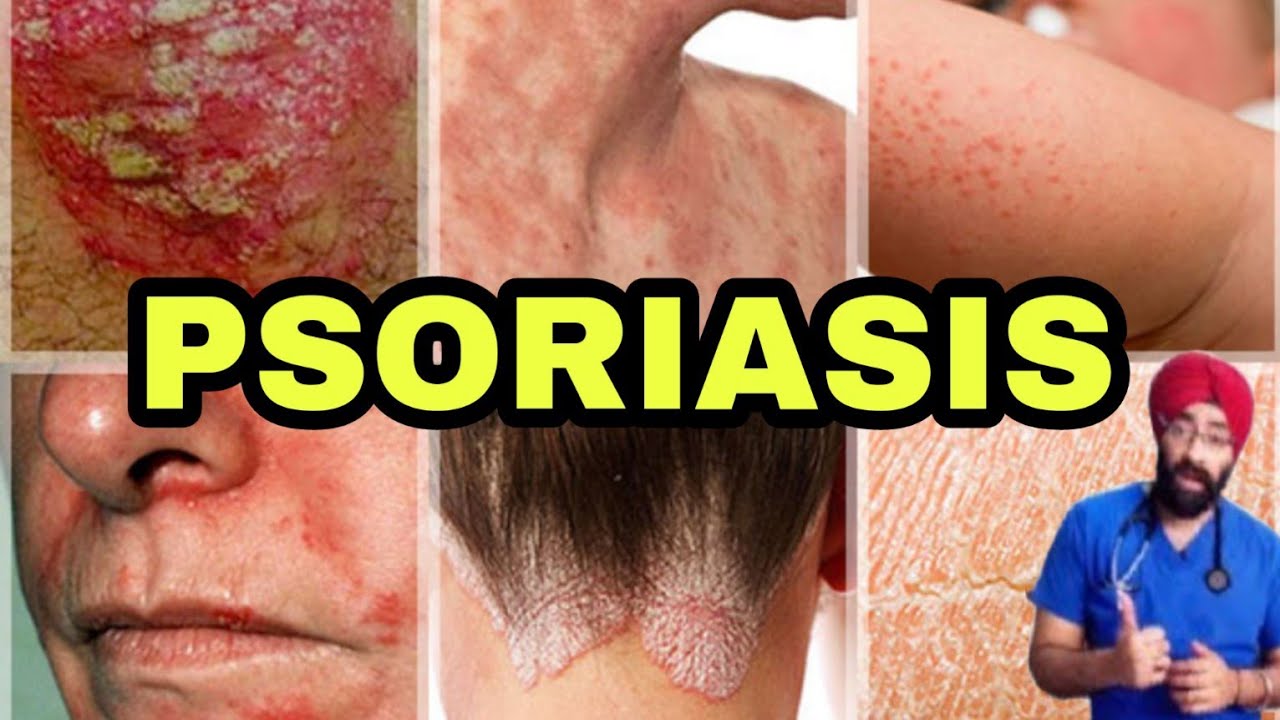 Science of PSORIASIS : CAUSE TO CURE | scales on body.. Explained in ...