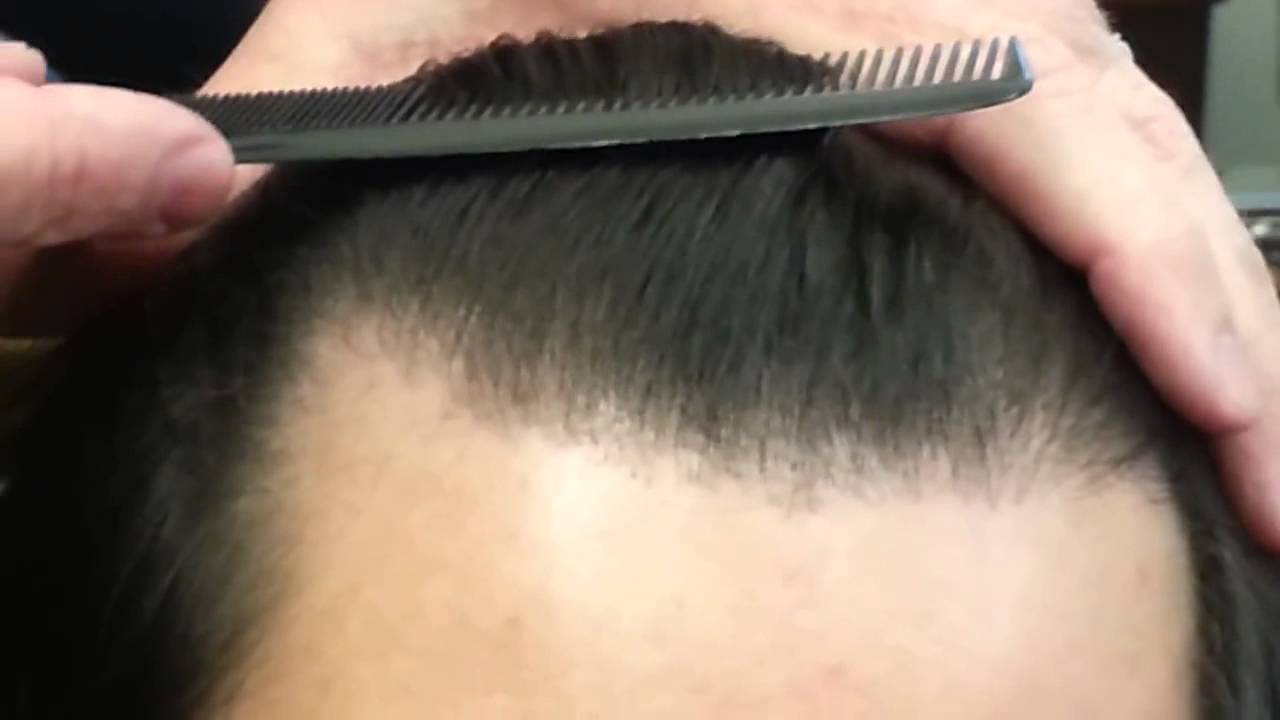 Hair Transplant hair line results by Dr Dan McGrath, Austin, Texas ...
