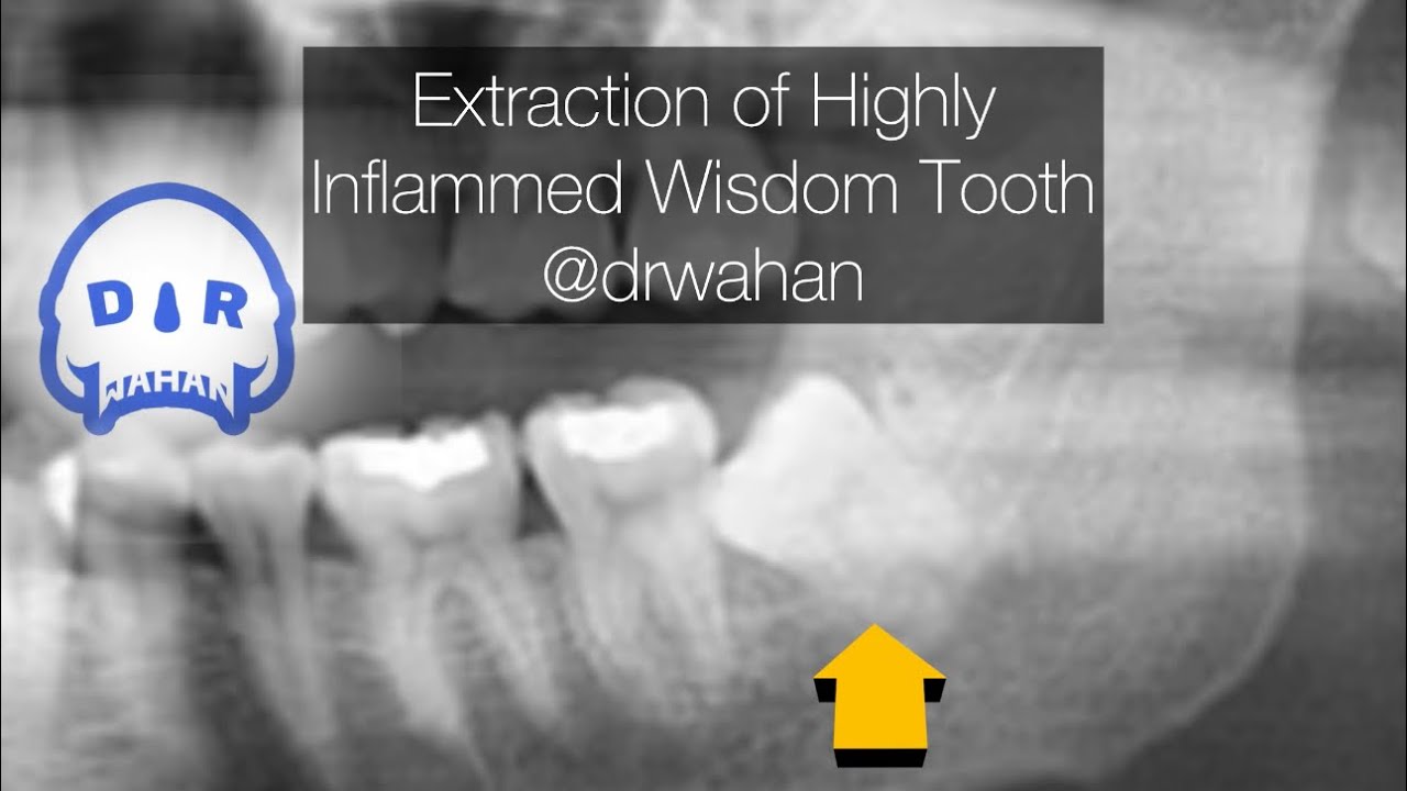 Highly Inflamed Wisdom Tooth Removal @drwahan - YouTube