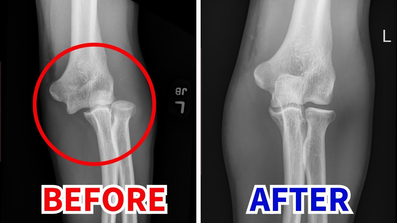 Elbow Dislocation Injury Recovery Part #1 - YouTube