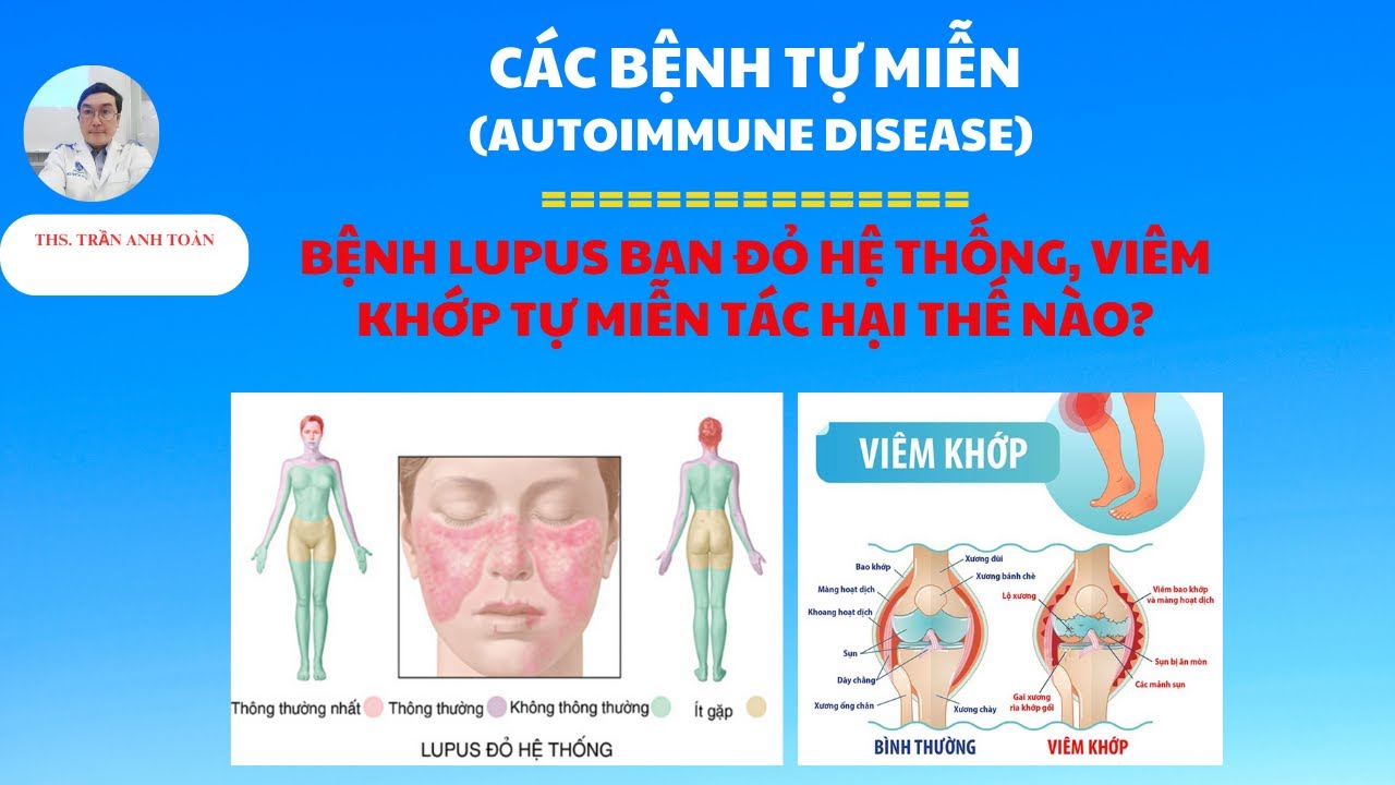 TÌM HIỂU CÁC BỆNH TỰ MIỄN DỊCH LÀ GÌ? - YouTube