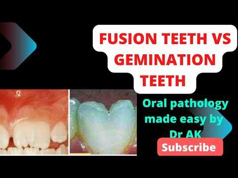 oral pathology lectures |difference between fusion/gemination teeth ...