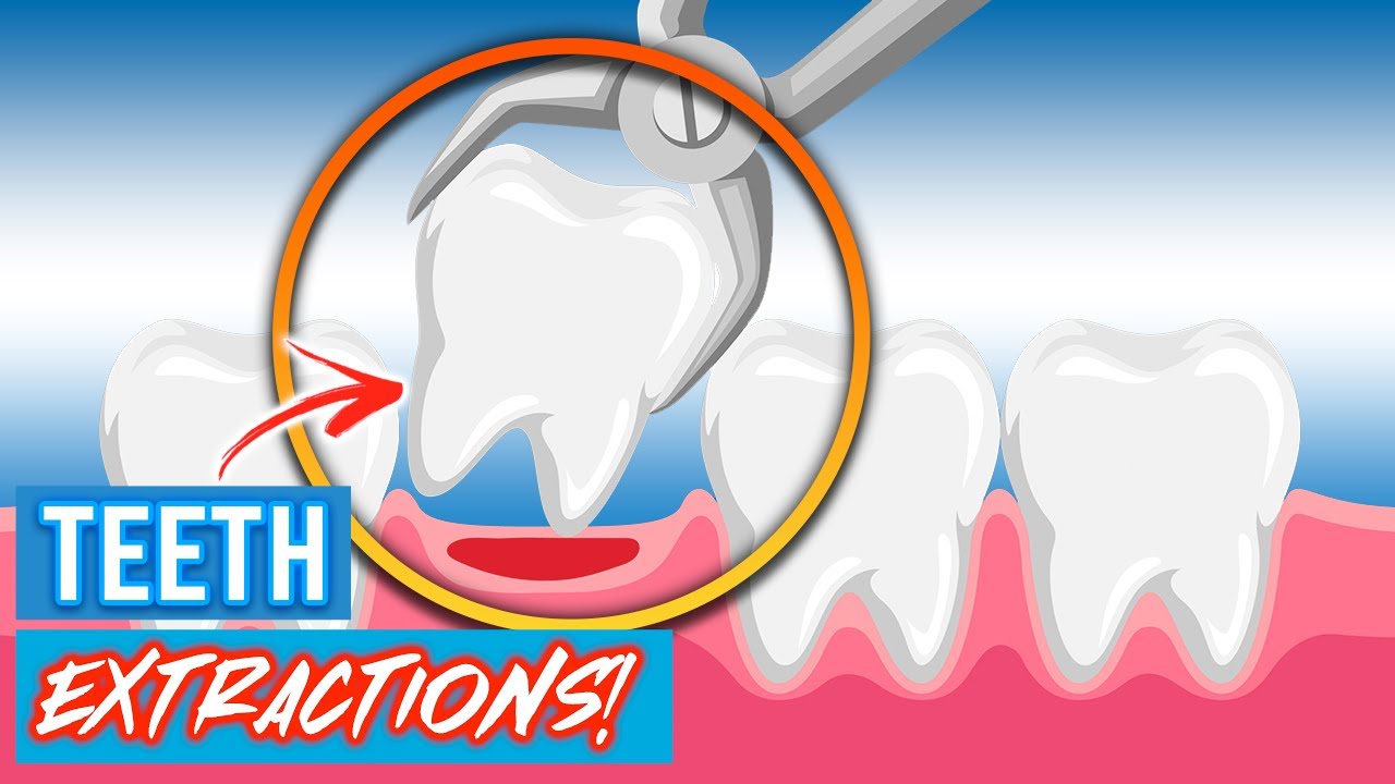 Tooth Extractions For Braces! | Why Do Orthodontists Extract Teeth ...