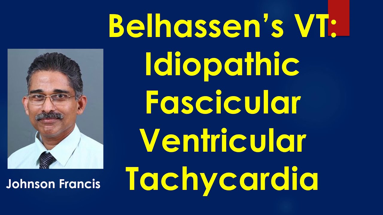 Belhassen’s VT: Idiopathic Fascicular Ventricular Tachycardia - YouTube