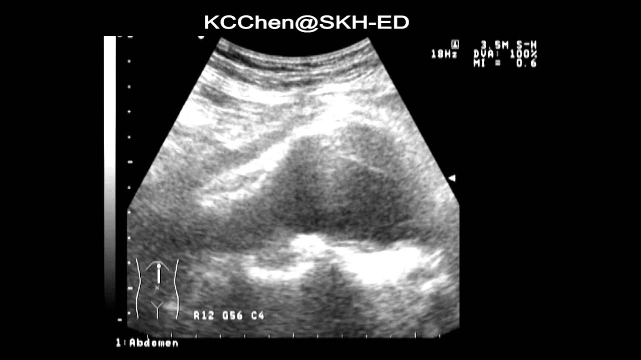 AAA_impending rupture - YouTube