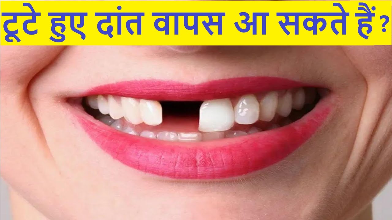 टूटे हुए दांत वापस आ सकते हैं || Back tooth/Molar tooth broke in half ...