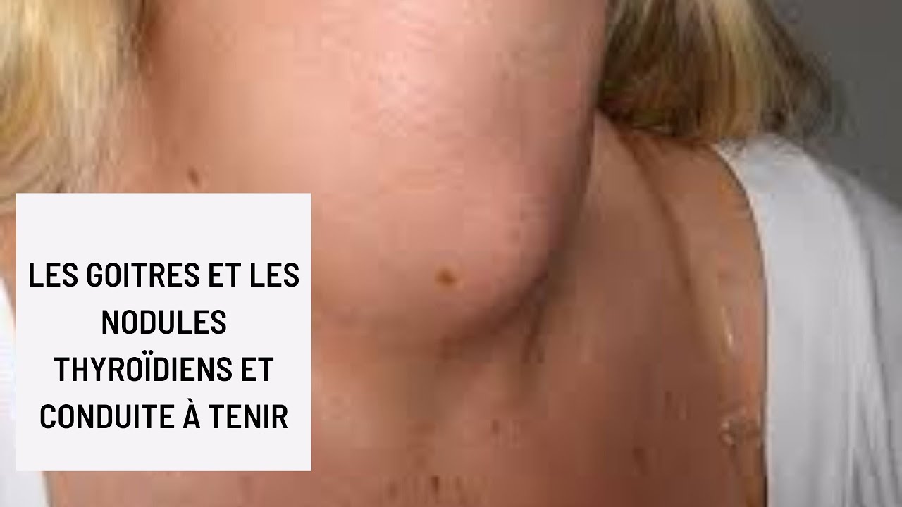 Les goitres et les nodules thyroïdiens et conduite à tenir - YouTube