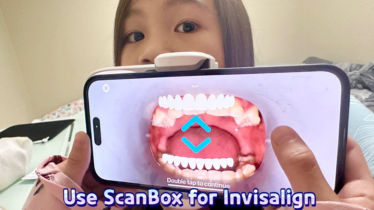 How to Use ScanBox to Scan Invisalign| Niền Răng Bằng Invisalign - YouTube