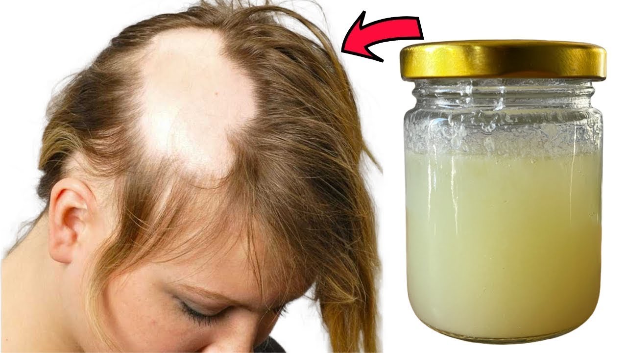 REMEDIO BOMBA💣😱 PARA LA CAÍDA DEL CABELLO Y EL CRECIMIENTO RÁPIDO ...