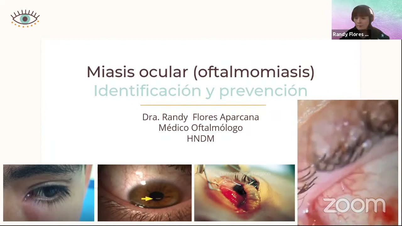 MIASIS OCULAR - YouTube
