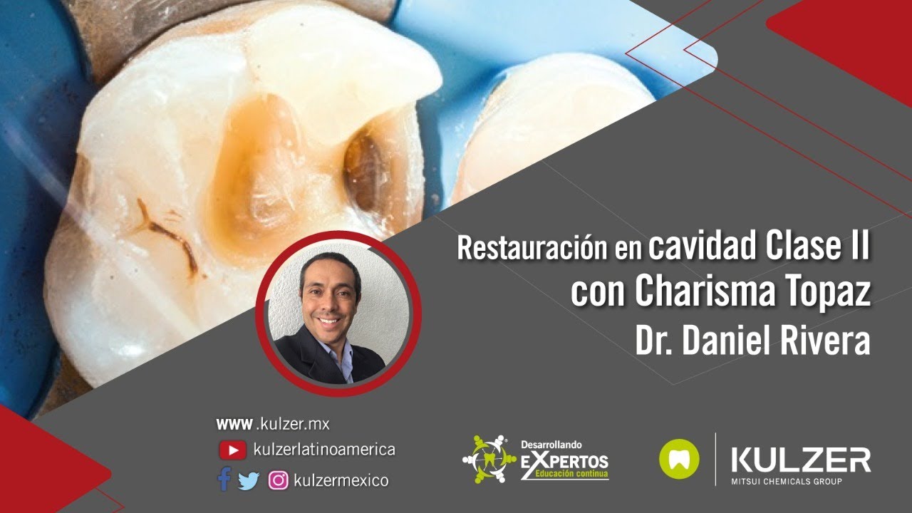 Restauración en cavidad clase II con resina Charisma Topaz - YouTube