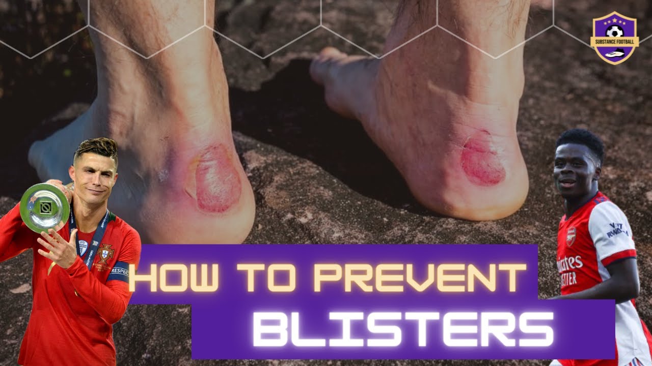 NEVER GET BLISTERS AGAIN WITH THESE TIPS! | How to Prevent Blisters ...