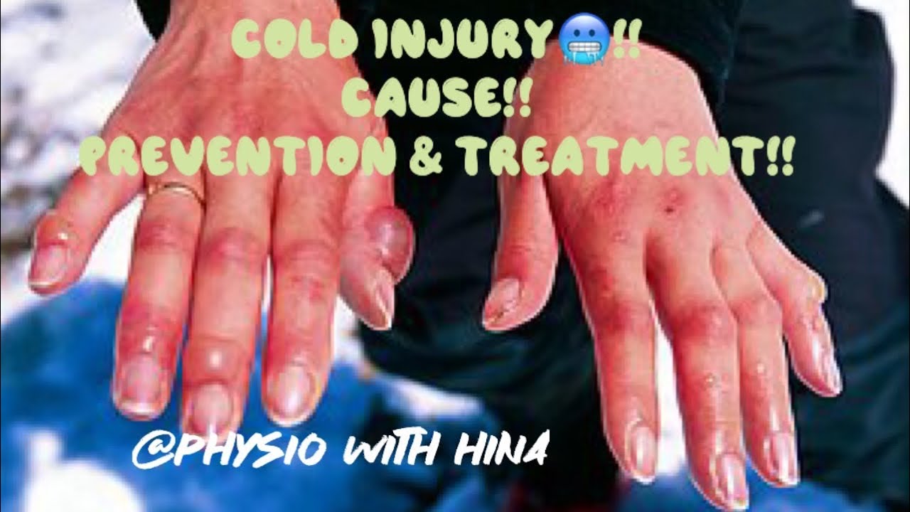 What is cold injury 🥶?? - YouTube