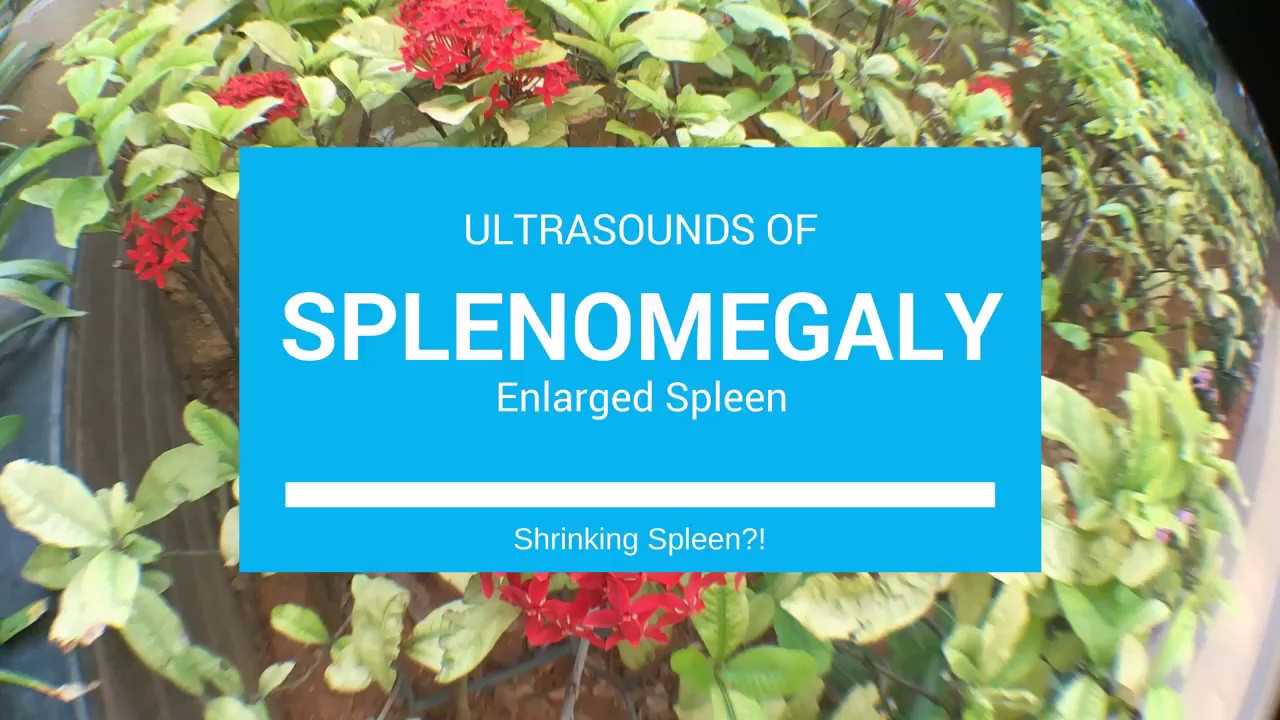 Splenomegaly with Ultrasound of Spleen Getting Smaller! Polycythemia ...