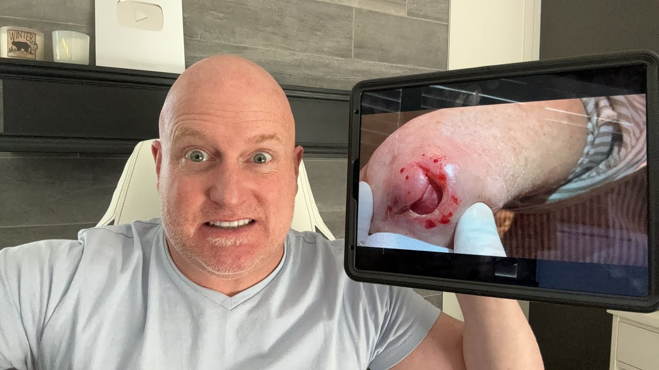 Going live now at MrPopZit Live! Laceration repair - a unique case ...