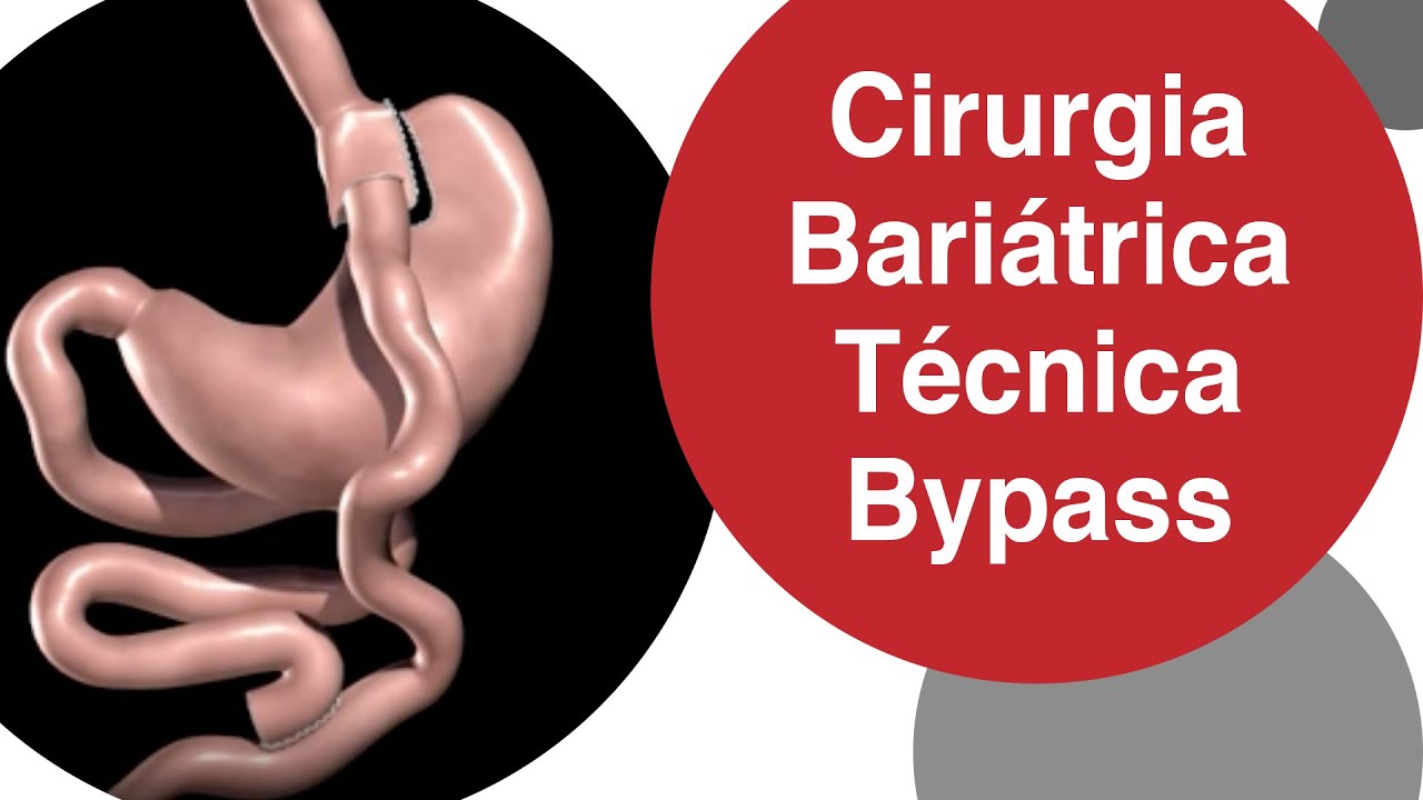 Vamos Aprender Sobre a Técnica do BYPASS? - YouTube