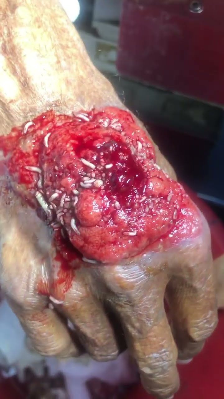 Maggots Infested Wound 😱| Surgery #shorts #doctor - YouTube