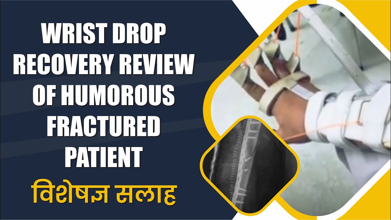 Hilarious Wrist Drop Recovery Review: Expert Advice from a Fractured ...