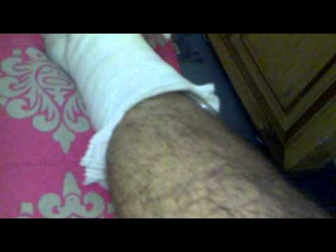 BONE FRACTURER CAST PLASTER ITCHING TOOLS USES 1 1(MAJESTIC PAKISTAN ...