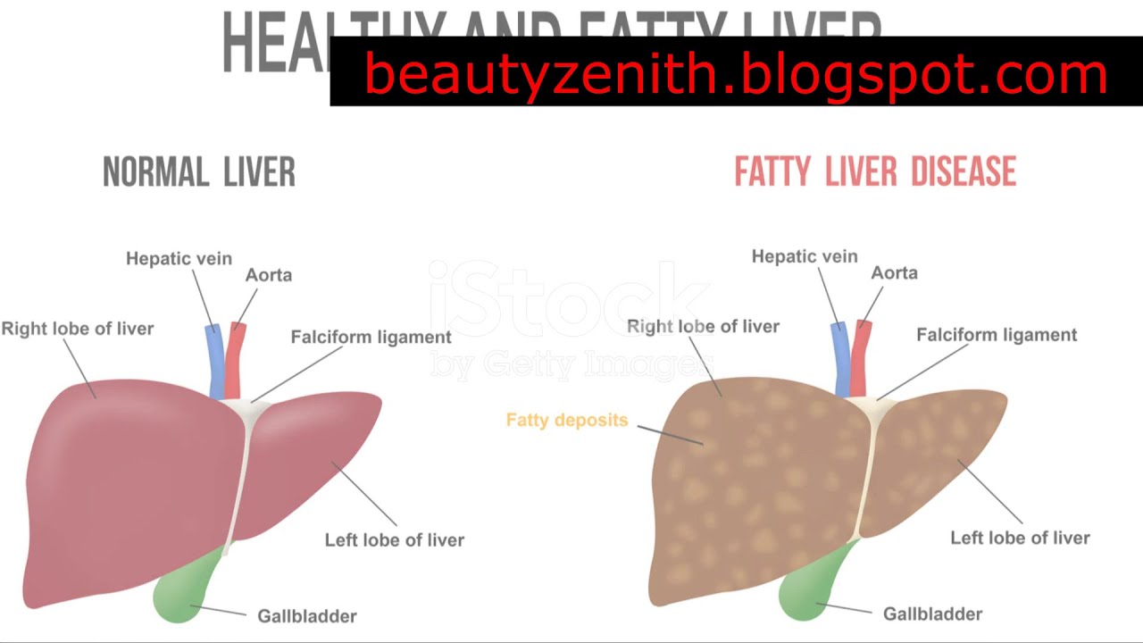 Top 5 Liver-Friendly Foods for Fatty Liver Recovery! - YouTube