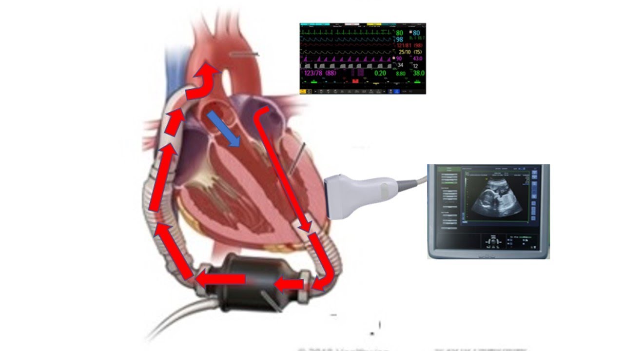 "Hemodynamic ramp test by simultaneous echocardiography and right heart ...