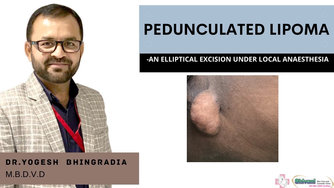 PEDUNCULATED LIPOMA | AN ELLIPTICAL EXCISION UNDER LOCAL ANAESTHESIA ...