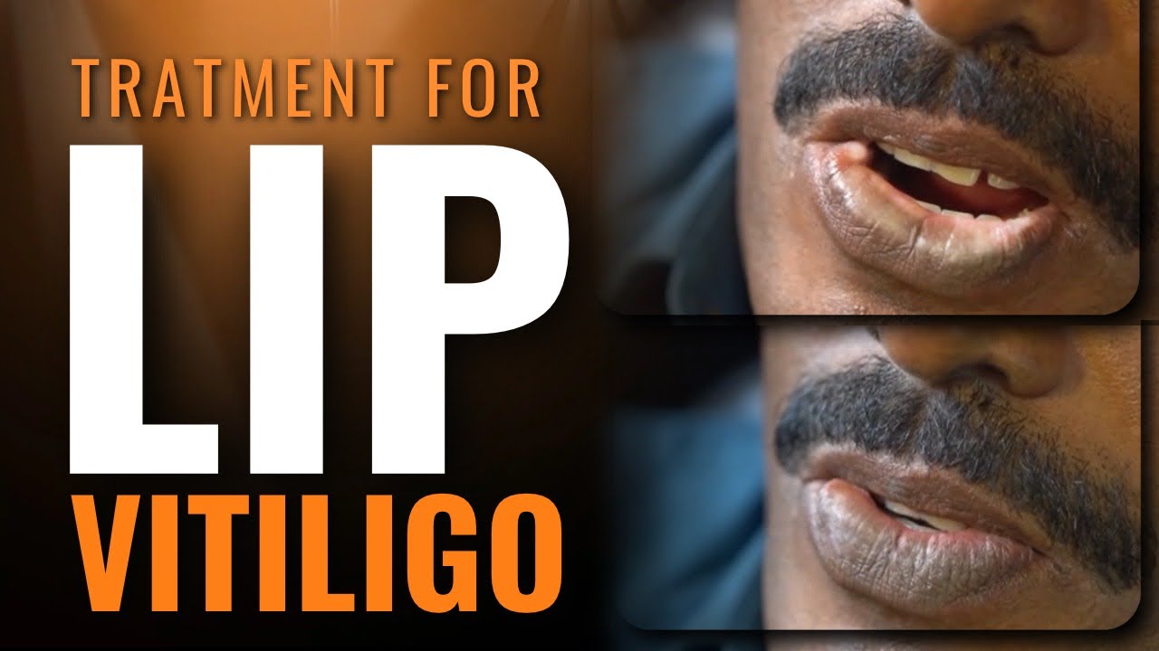 Treatment for Lip Vitiligo | Best permanent solution | Bangalore ...