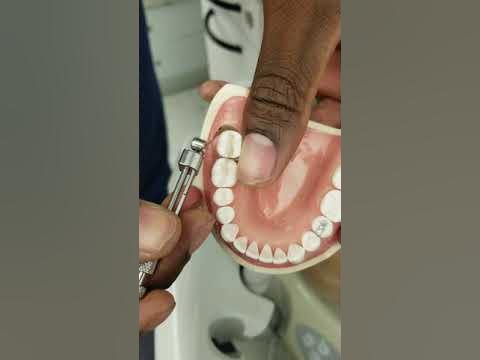 How to place tofflemire and matrix band - YouTube